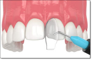 How Cosmetic Dental Bonding Fixes Minor Gaps - Kiessling Family Dentistry